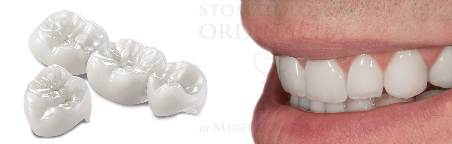 Vrste Zubnih Krunica, Cirkonijum Krunice, E Max Krunice